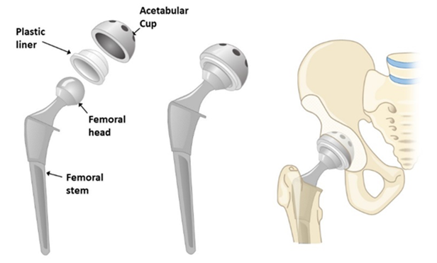 Joint Replacement Design in Discovery | Education Resources