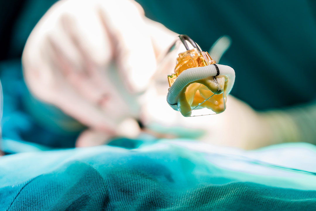 Cardiovascular & Blood Flow Simulation Software | Ansys