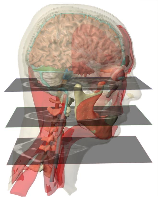 Eliminate Football Concussion with Shocking Simulation | Ansys Eliminate Football Concussion with Shocking Simulation | Ansys