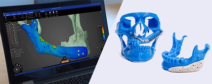 Repairing Bone Loss with Simulation-Generated, Patient-Specific ...