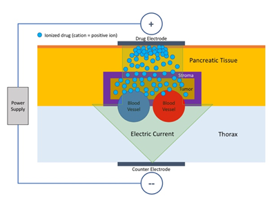 Simulation Optimizes a Chemotherapy Implant to Treat Pancreatic Cancer ...